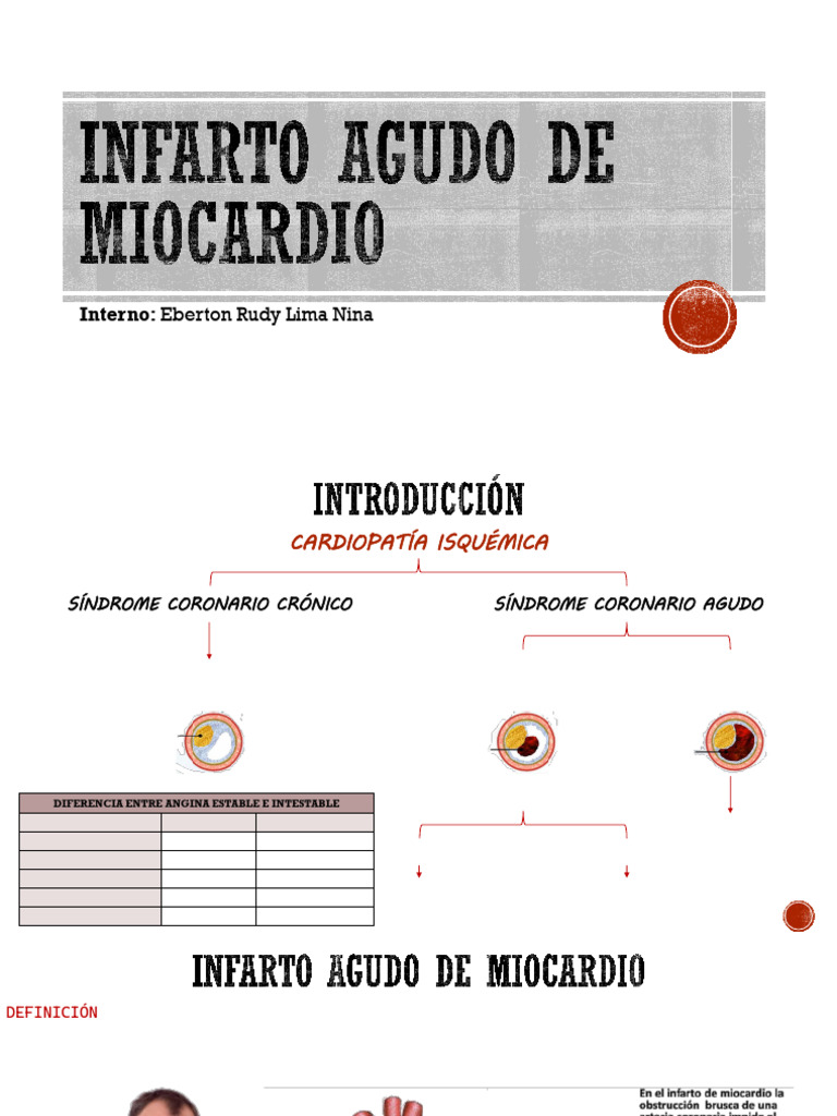 Infarto Agudo de Miocardio | PDF | Infarto de miocardio | Aterosclerosis