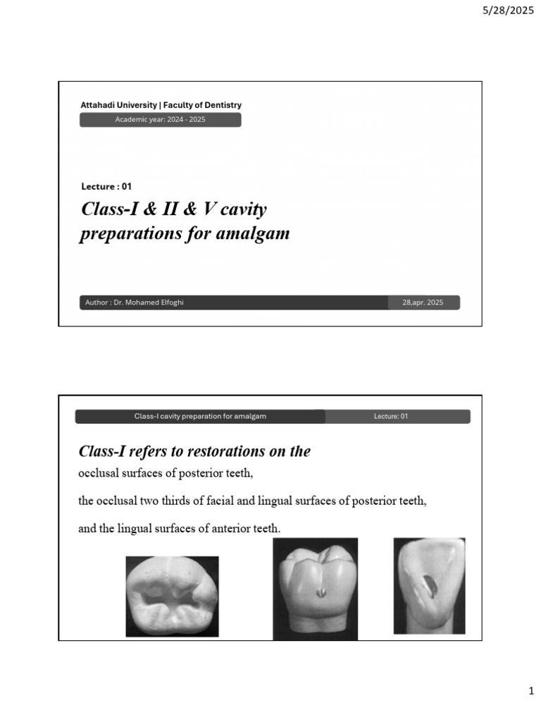 Class-I, II, V Cavity Preparation For Amalgam - 250529 - 172753 | PDF ...