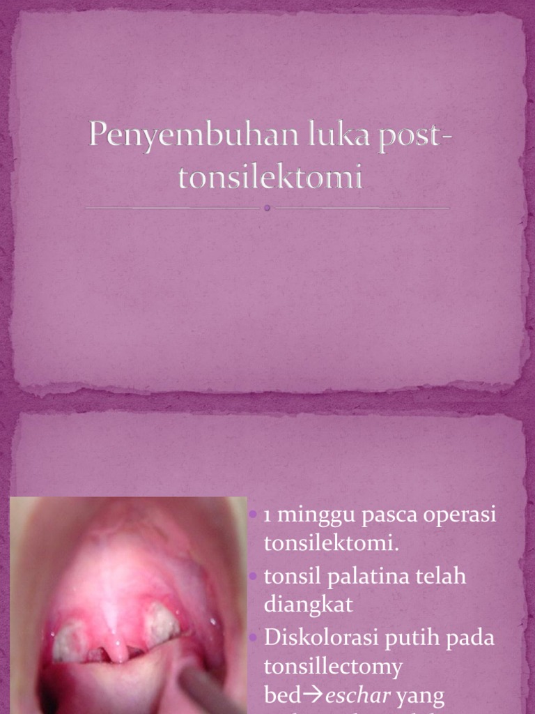 Presentation Orofaring Dan Diet Post Tonsillectomy | PDF