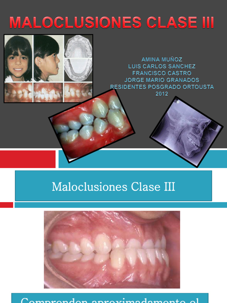 Tratamiento de La Maloclusión Clase III PDF | PDF | Ortodoncia | Ramas ...