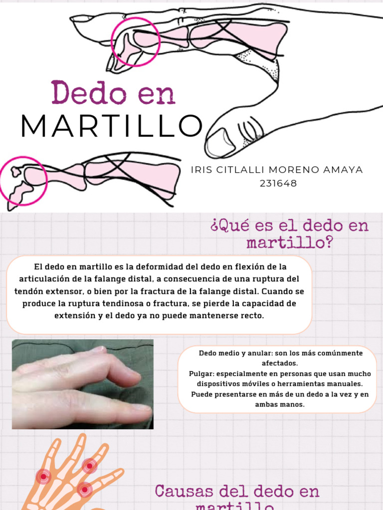 Dedo en Gatillo | PDF | Tendón | Enfermedades y trastornos
