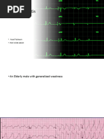 Sgarbossa Criteria - LITFL - ECG Library Diagnosis | PDF ...