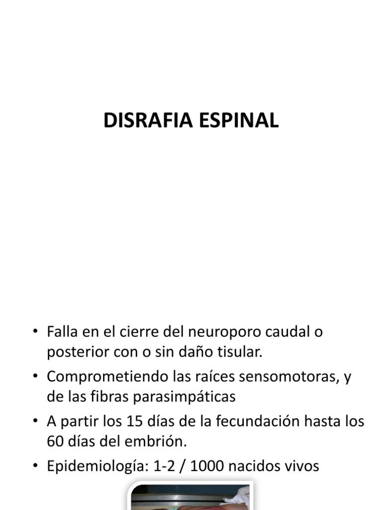 Disrafia Espinal | PDF | Rtt | Medicina