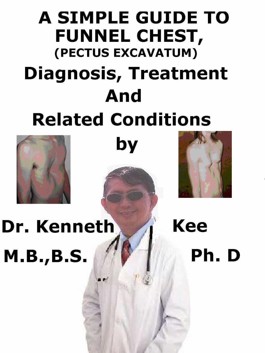 A Simple Guide to Funnel Chest (Pectus Excavatum), Diagnosis, Treatment ...