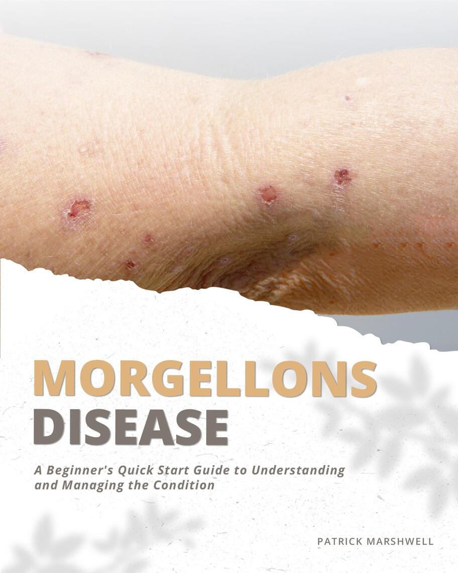 Morgellons Disease by Patrick Marshwell (Ebook) - Read free for 30 days